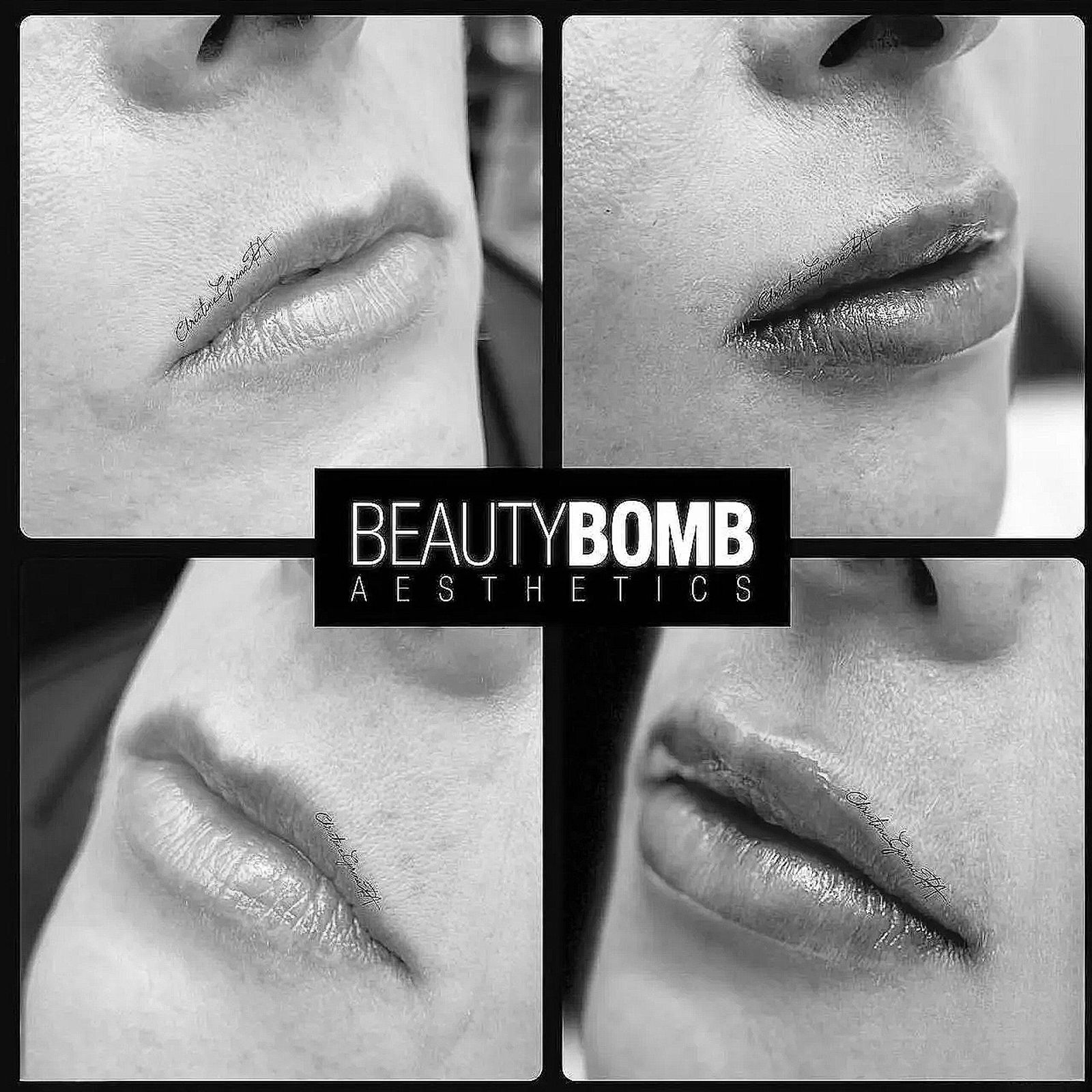 Medical Spa & Botox in Smithtown, NY - Beauty Bomb Aesthetics